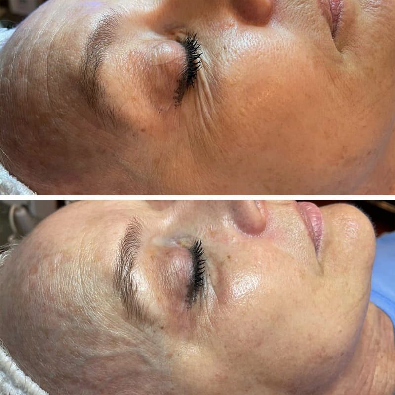 Face - Boca Raton Laser Lipo